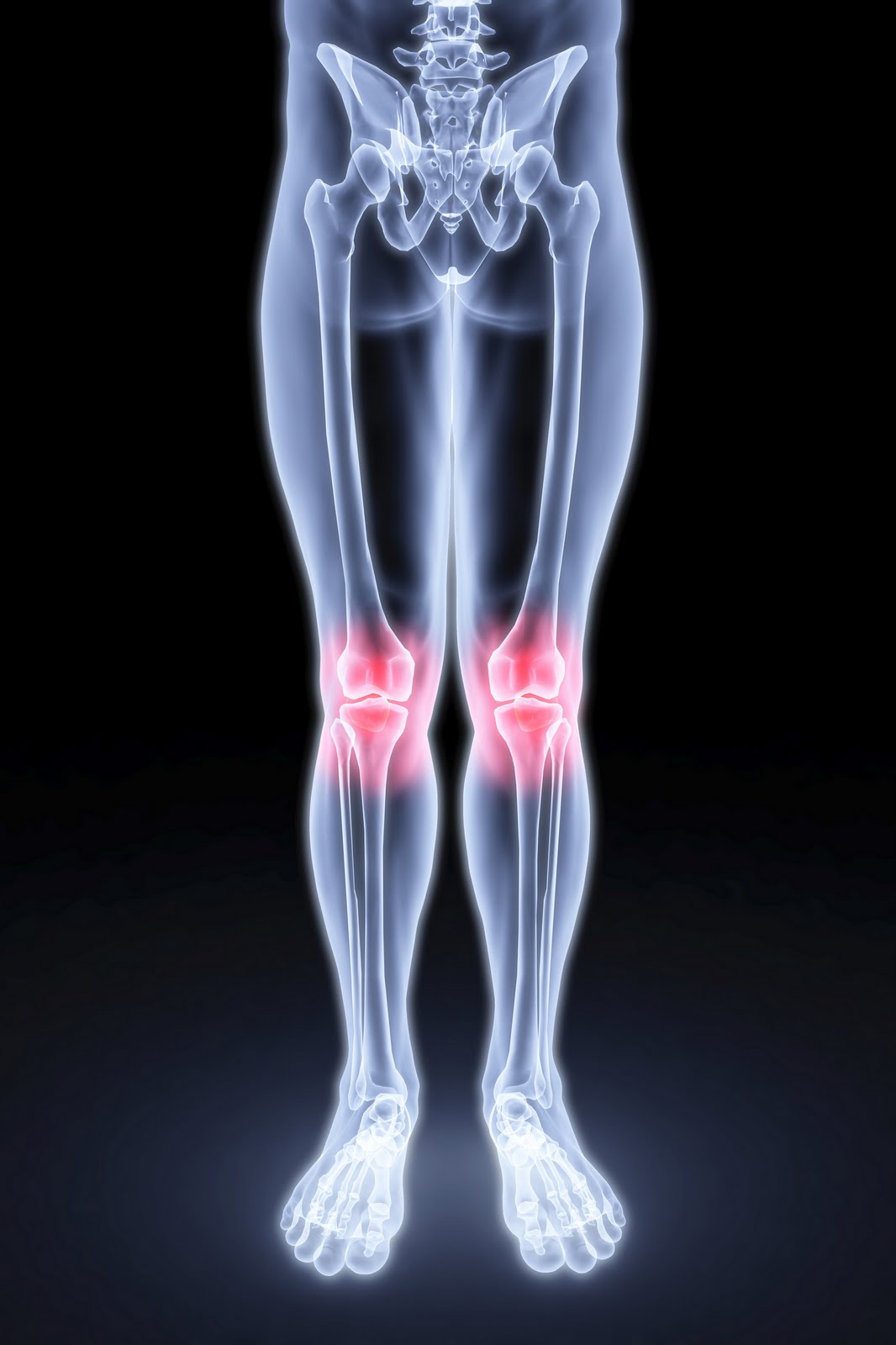 Varus Deformation Correction in Turkey | Affordable Orthopedic Surgery